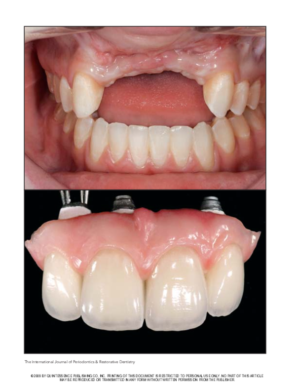 (PDF) Prosthetic gingival reconstruction in fixed partial restorations ...
