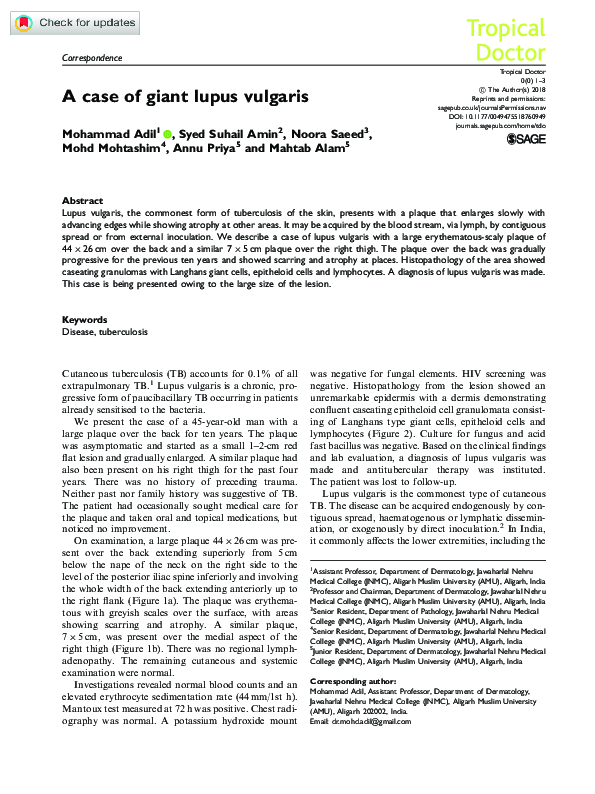 (PDF) A case of giant lupus vulgaris