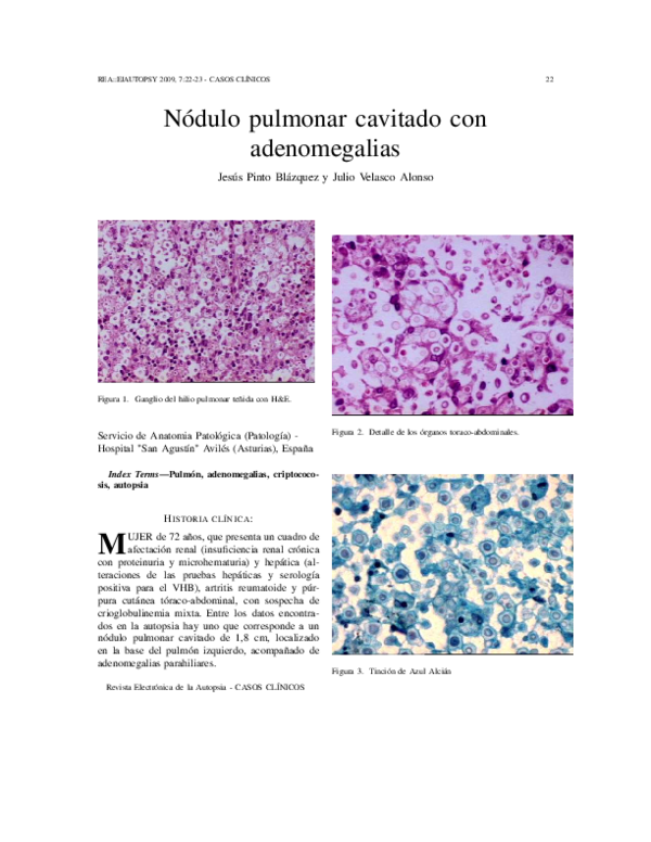 (PDF) Nódulo pulmonar cavitado con adenomegalias
