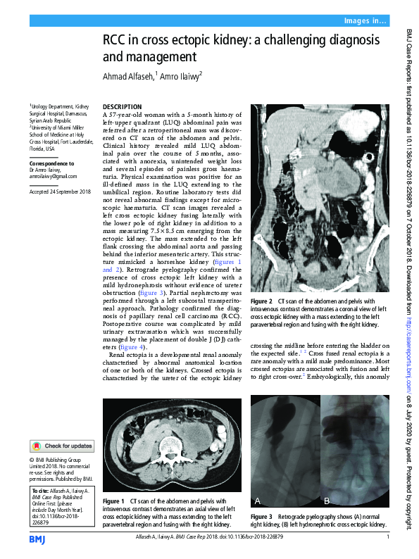 (PDF) RCC in cross ectopic kidney: a challenging diagnosis and management