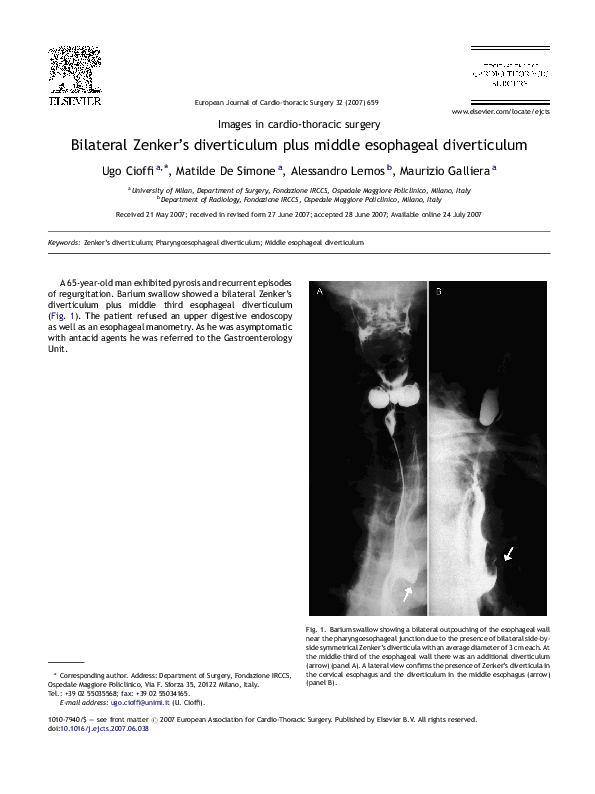 (PDF) Bilateral Zenker's diverticulum plus middle esophageal diverticulum