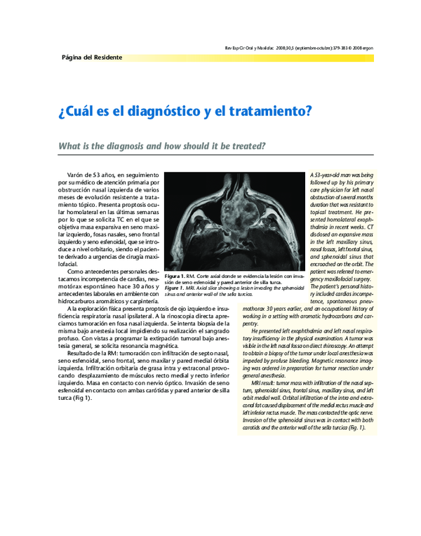 (PDF) Sarcoma osteogénico naso-maxilo-orbitario: Abordaje transcraneal