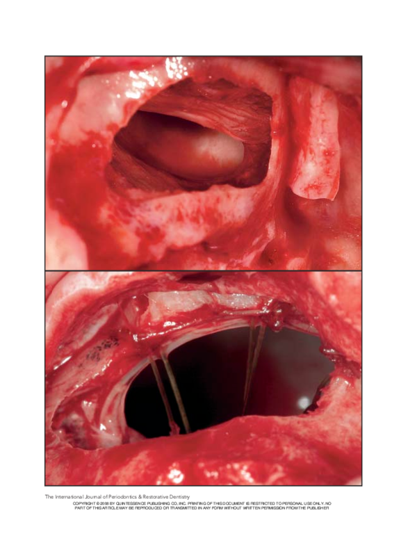 (PDF) Repair of large sinus membrane perforations using stabilized ...