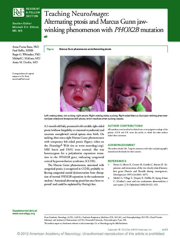 (PDF) Teaching NeuroImages: Alternating ptosis and Marcus Gunn jaw ...
