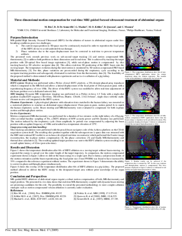 (PDF) Three Dimensional Motion Compensation for Real-Time MRI Guided Focused Ultrasound ...