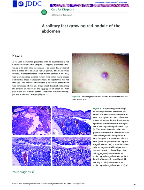 (PDF) A solitary fast growing red nodule of the abdomen