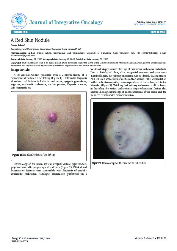 (PDF) A Red Skin Nodule