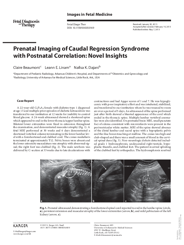(PDF) Prenatal Imaging of Caudal Regression Syndrome with Postnatal ...