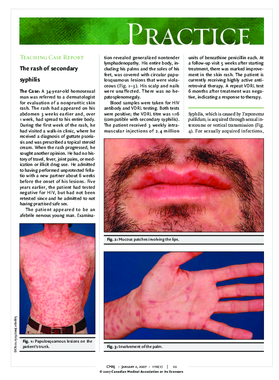 (PDF) The rash of secondary syphilis