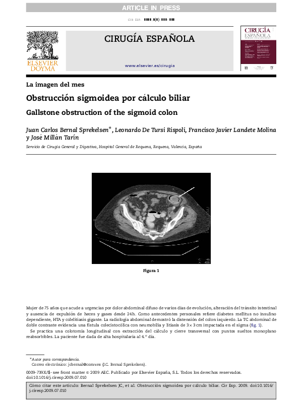 (PDF) Obstrucción sigmoidea por cálculo biliar