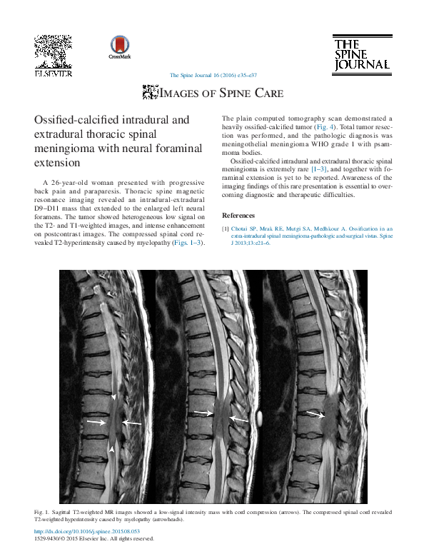 (PDF) Ossified-calcified intradural and extradural thoracic spinal ...