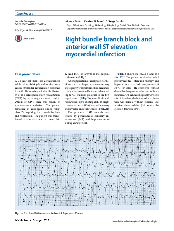 (PDF) Right bundle branch block and anterior wall ST elevation ...