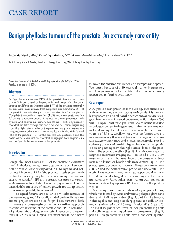 (PDF) Benign phyllodes tumour of the prostate: An extremely rare entity
