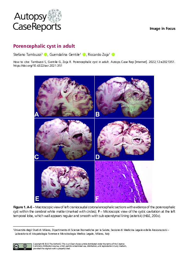 (PDF) Porencephalic cyst in adult