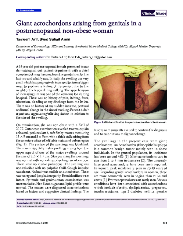 (PDF) Giant acrochordons arising from genitals in a postmenopausal non ...