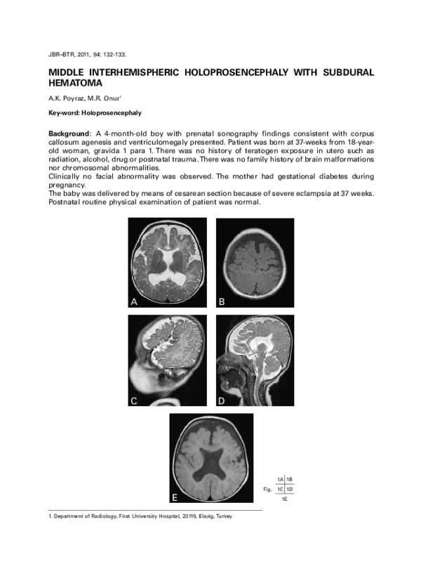 (PDF) Middle interhemispheric holoprosencephaly with subdural hematoma