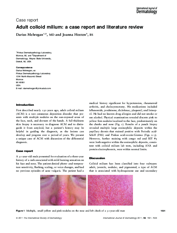 (PDF) Adult colloid milium: a case report and literature review