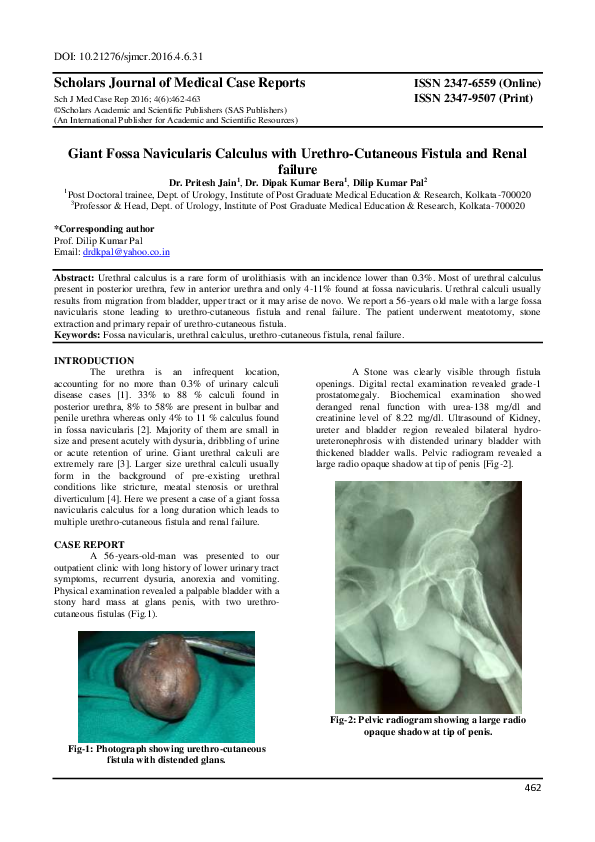 (PDF) Giant Fossa Navicularis Calculus with Urethro-Cutaneous Fistula ...
