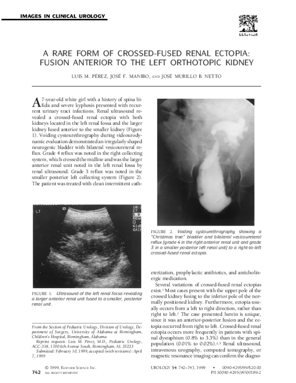 (PDF) A rare form of crossed-fused renal ectopia: fusion anterior to ...