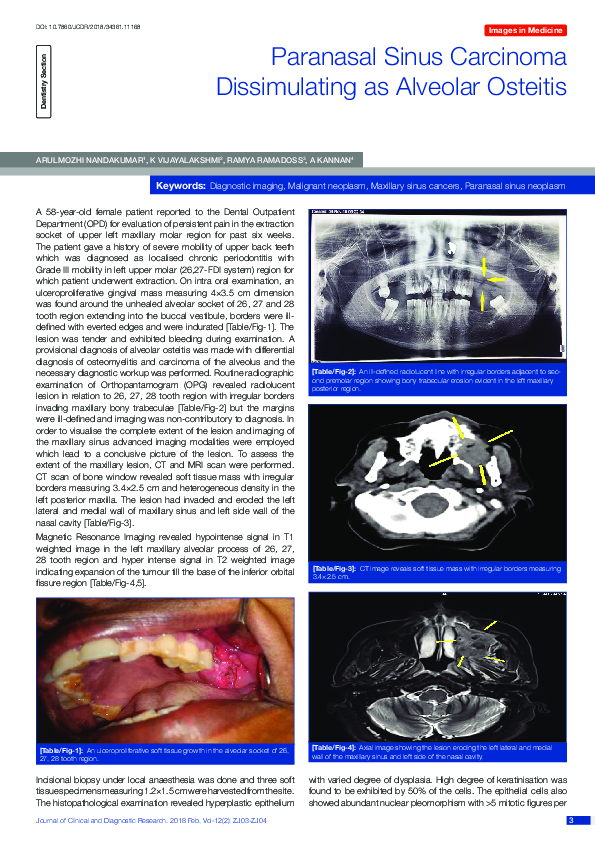 (PDF) Paranasal Sinus Carcinoma Dissimulating as Alveolar Osteitis