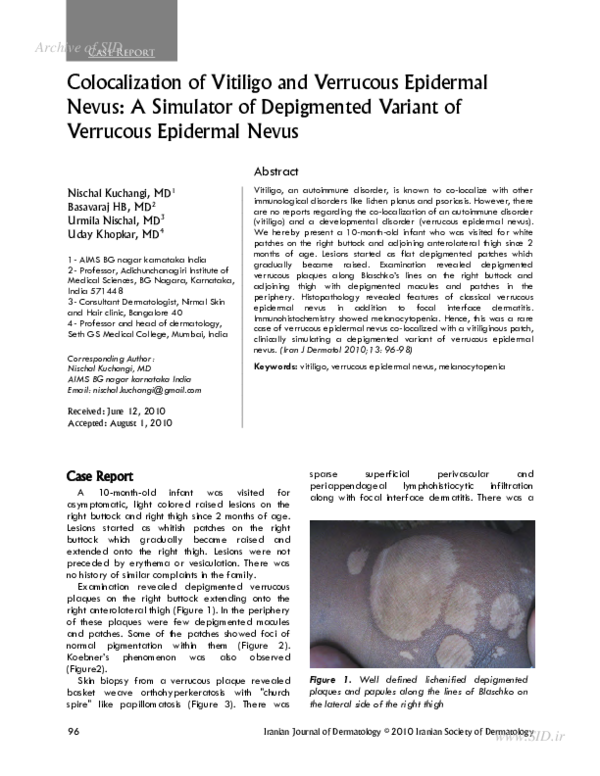 (PDF) Colocalization of Vitiligo and Verrucous Epidermal Nevus: A ...