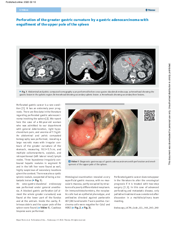(PDF) Perforation of the greater gastric curvature by a gastric ...