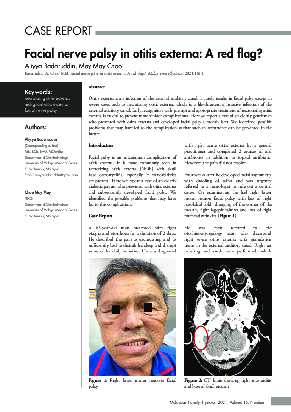 (PDF) Facial nerve palsy in otitis externa: A red flag?