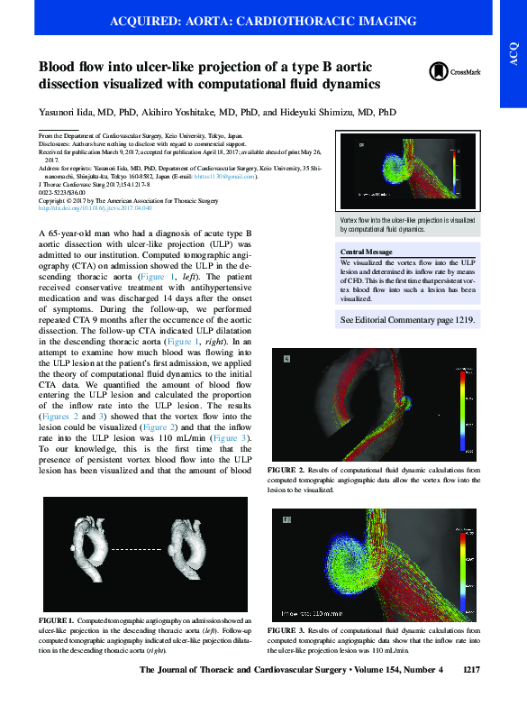 (PDF) Blood flow into ulcer-like projection of a type B aortic ...