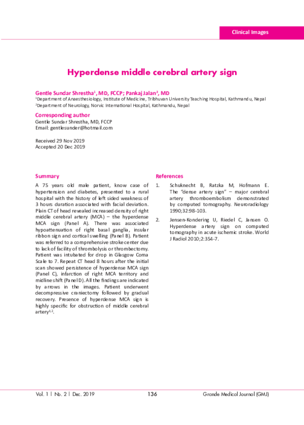 (PDF) Hyperdense middle cerebral artery sign