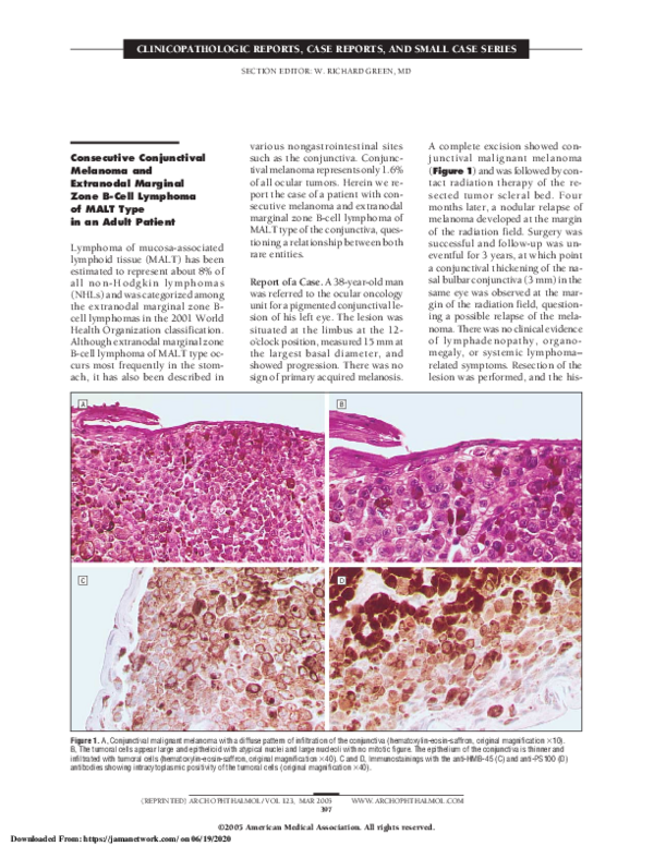 (PDF) Consecutive Conjunctival Melanoma and Extranodal Marginal Zone B ...