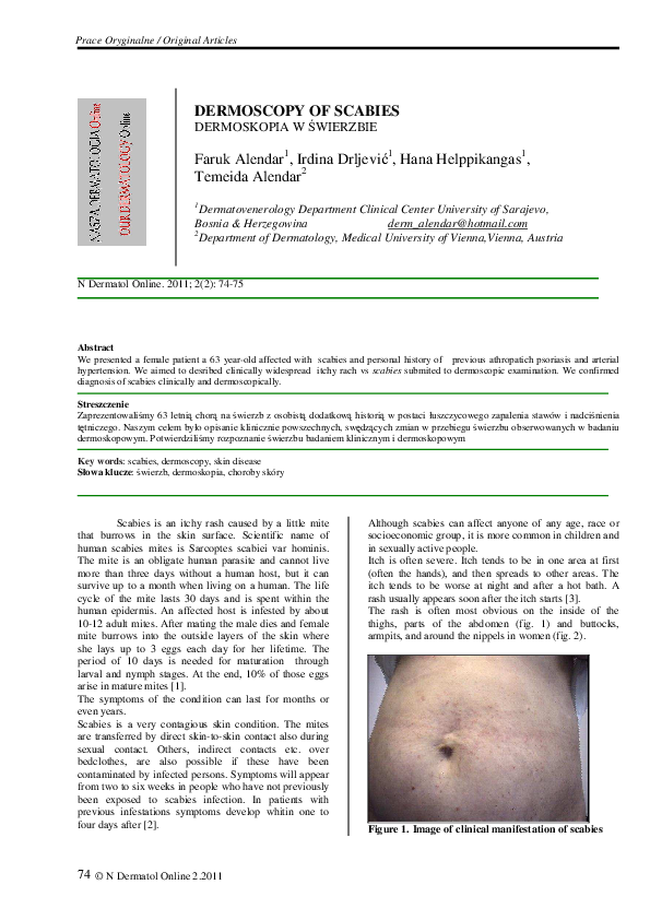 (PDF) Dermoscopy of Scabies