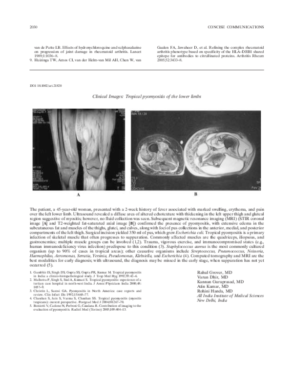 Tropical pyomyositis of the lower limbs