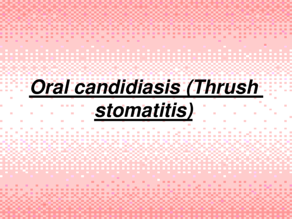 (PPT) 2 Oral candidiasis Thrush stomatitis