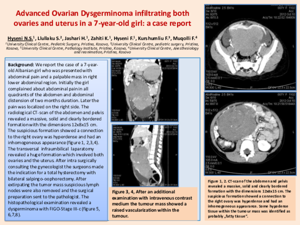 (PPT) Advanced Ovarian Dysgerminoma infiltrating both ovaries and uterus in a 7-year-old girl: a ...