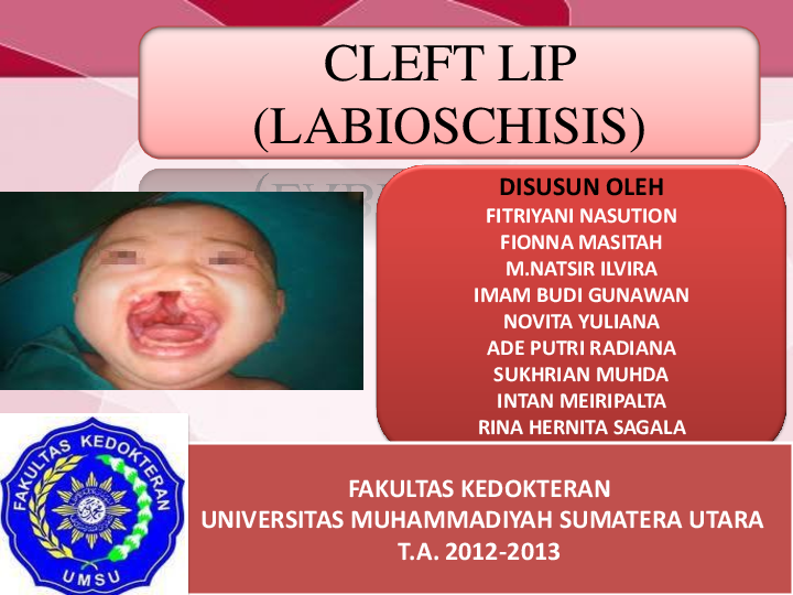 (PDF) CLEFT LIP (LABIOSCHISIS) DISUSUN OLEH
