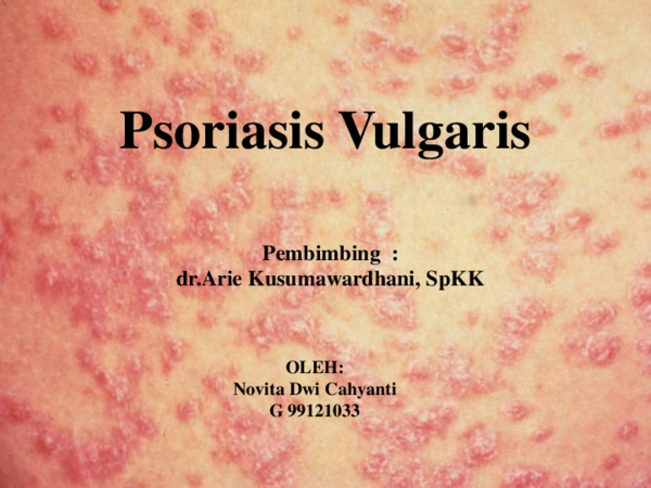 (PPT) psoriasis