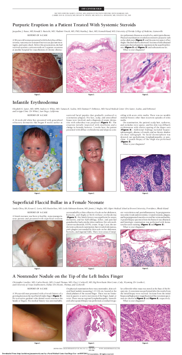 (PDF) OFF-CENTER FOLD Purpuric Eruption in a Patient Treated With ...