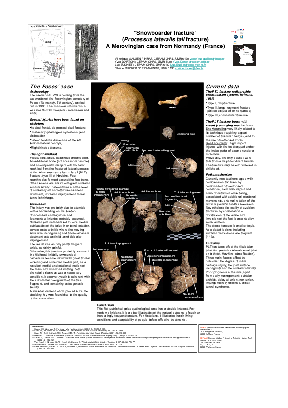 (PDF) "Snowboarder fracture" (Processus lateralis tali fracture). A ...