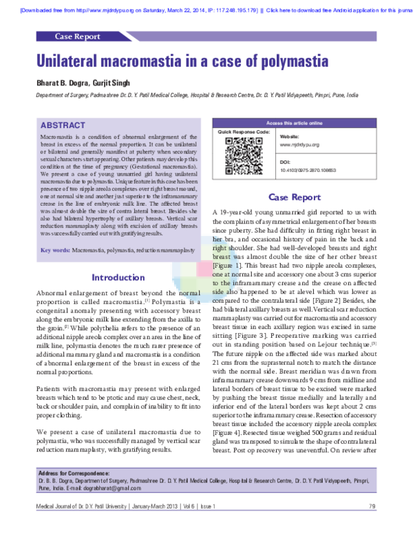 (PDF) Unilateral macromastia