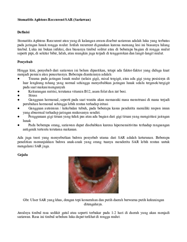 (PDF) Stomatitis Aphtous Reccurent/SAR (Sariawan