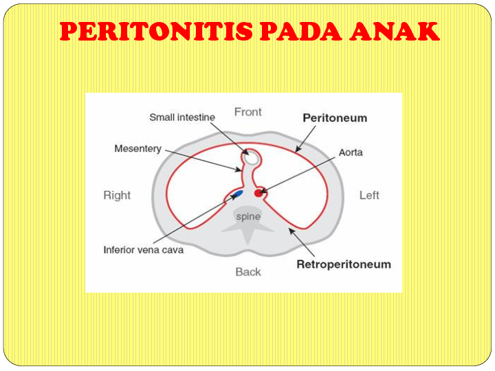 (PPT) Peritonitis Pada Anak