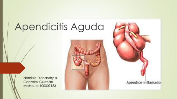 (PPT) Apendicitis Aguda