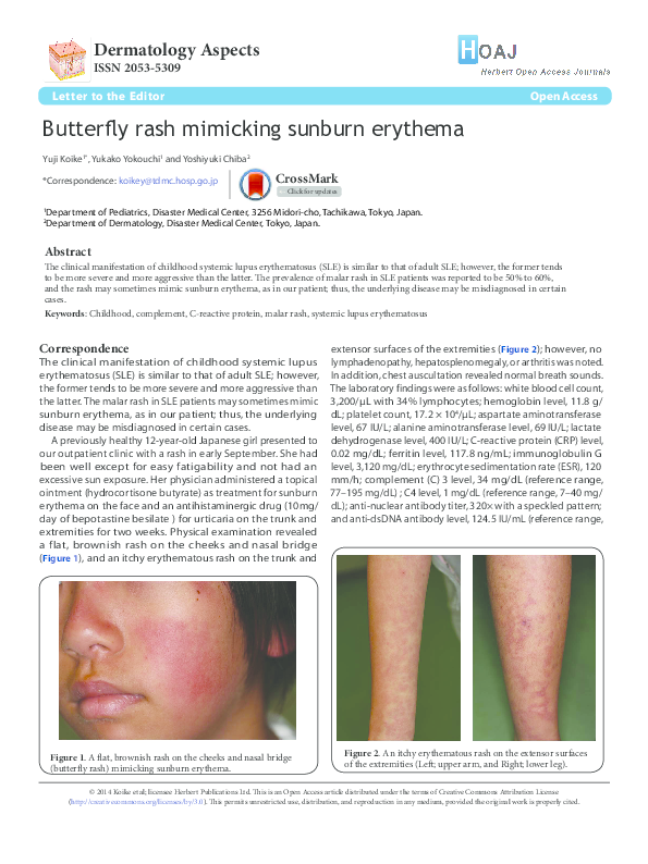 (PDF) Butterfly rash mimicking sunburn erythema