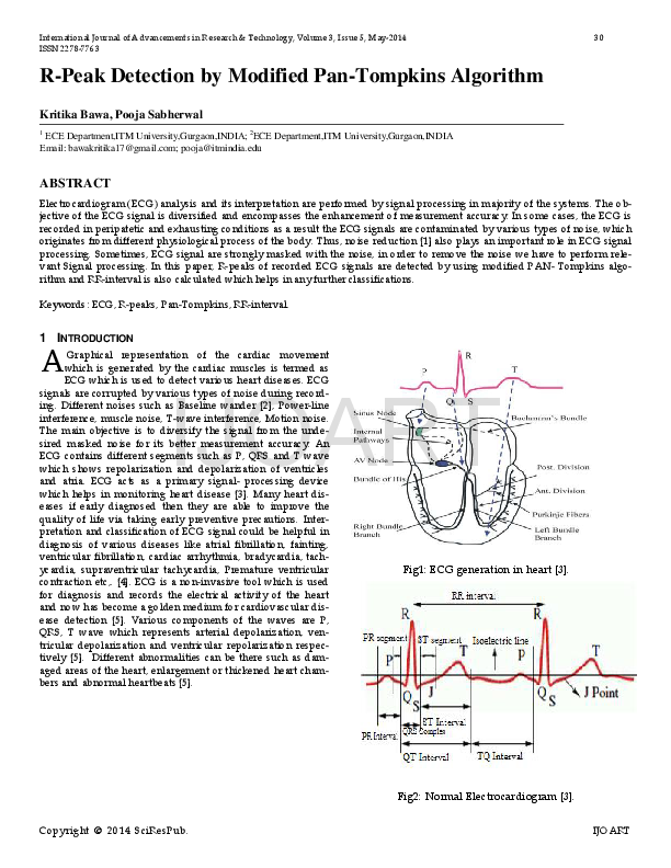 (PDF) R-Peak Detection by Modified Pan-Tompkins Algorithm