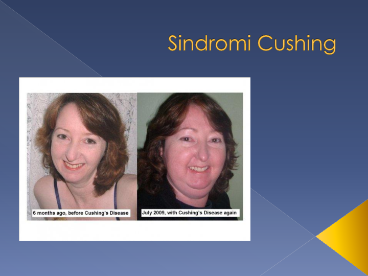 (PPT) Sindroma Cushing