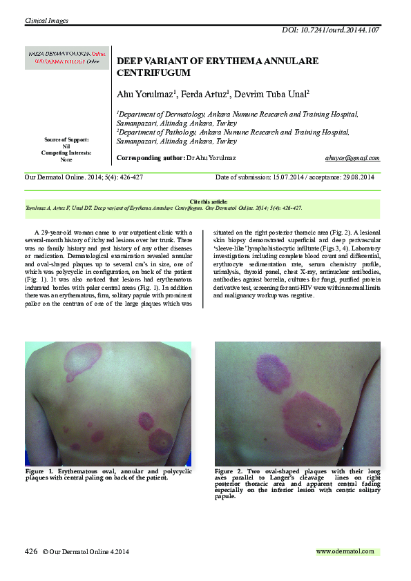 (PDF) Deep variant of Erythema Annulare Centrifugum