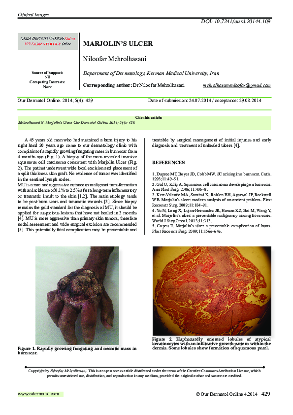 (PDF) Marjolin's Ulcer