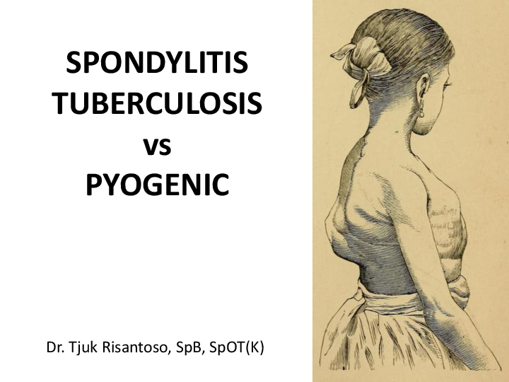 (PPT) Spondylitis TB vs Pyogenic