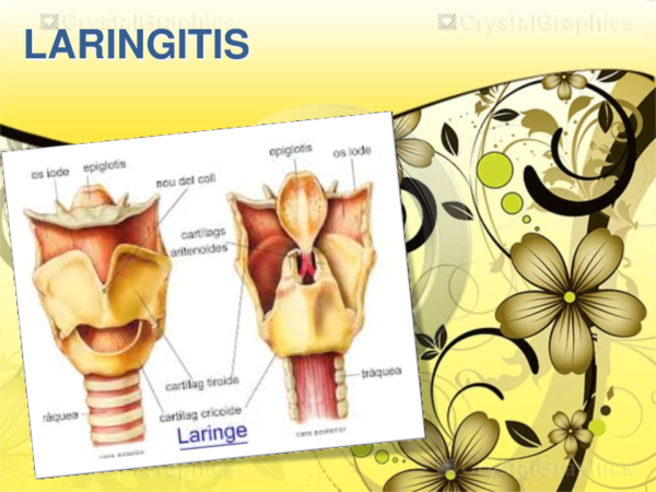 (PPT) LARINGITIS