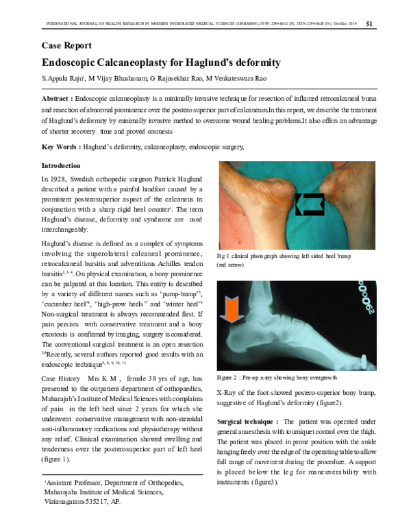 (PDF) Endoscopic Calcaneoplasty for Haglund's deformity